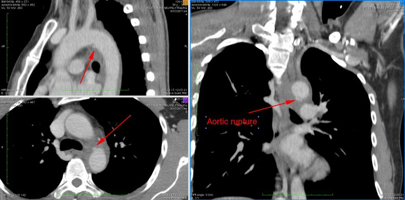 Case Reports | SwissACS (Acute Care Surgery) trauma, critical care ...