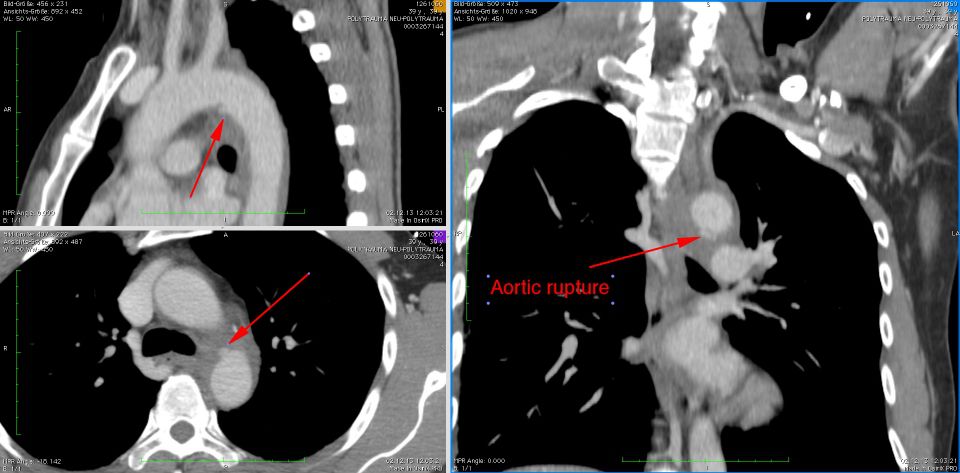 traumatic aortic rupture
